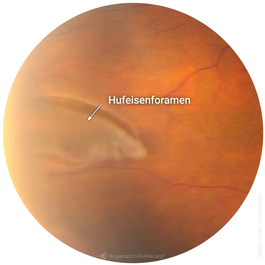 Netzhautlaser (Argon) - Augenzentrum Angermann